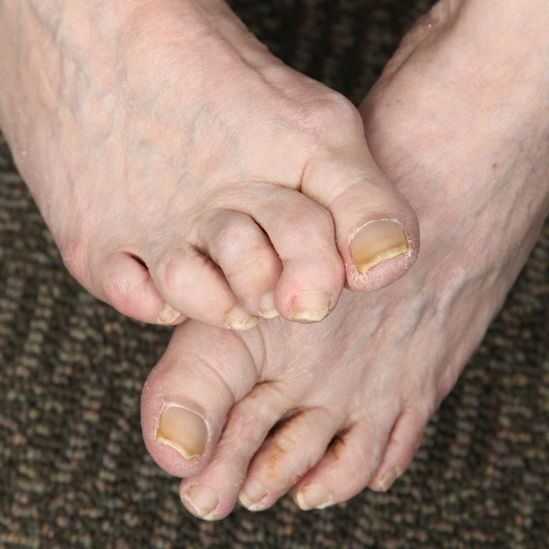 Podiatrist Near Me That Accepts Humana - Dr. Muroff
